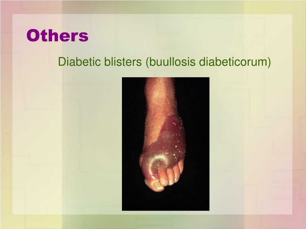 PPT - Skin manifestations of Diabetes (2006) PowerPoint Presentation ...