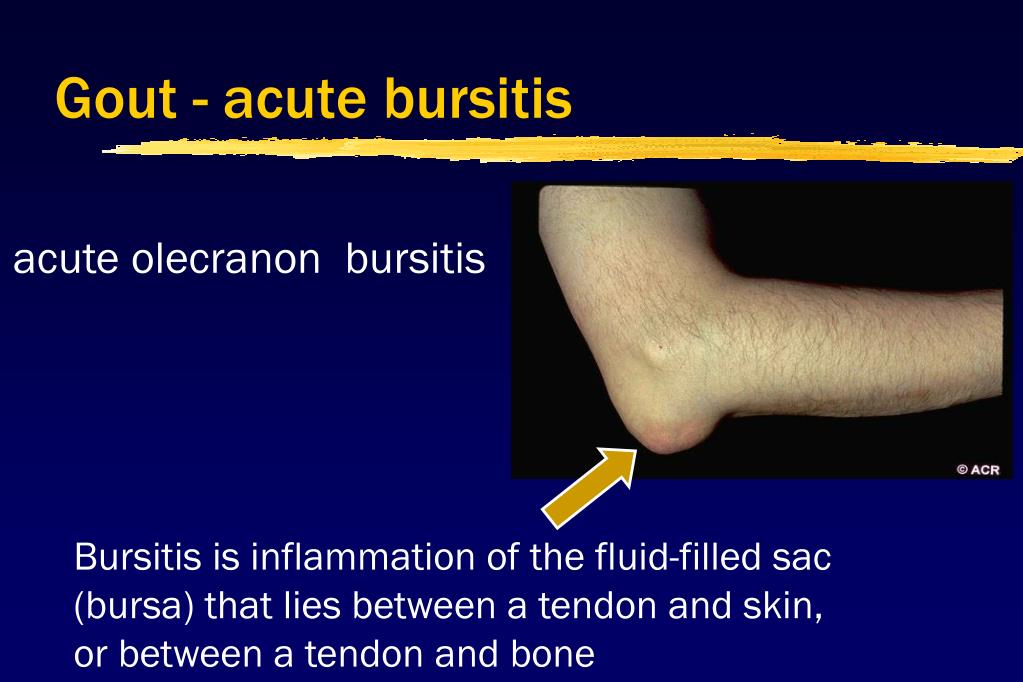 PPT - Drug Therapy of Gout PowerPoint Presentation, free download - ID ...