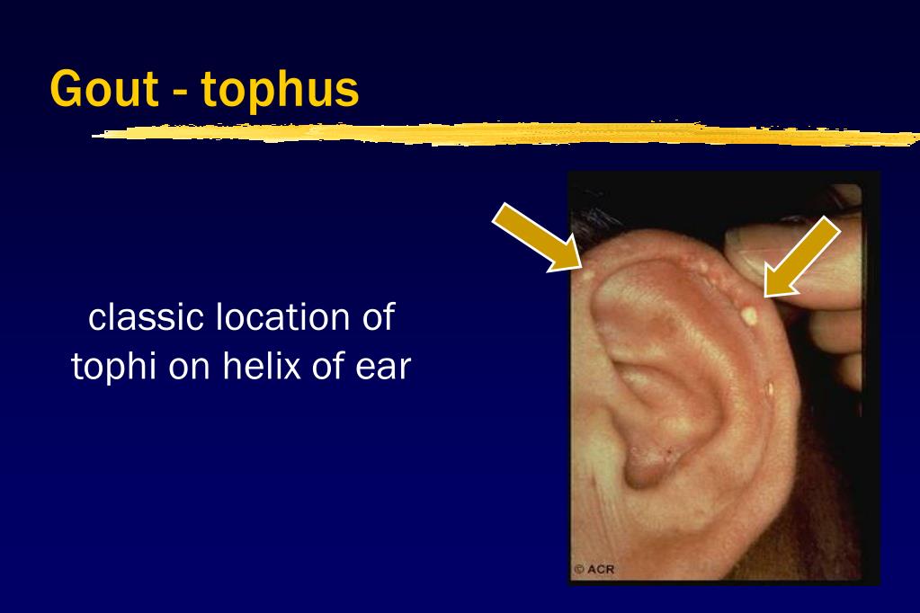 PPT - Drug Therapy of Gout PowerPoint Presentation, free download - ID ...