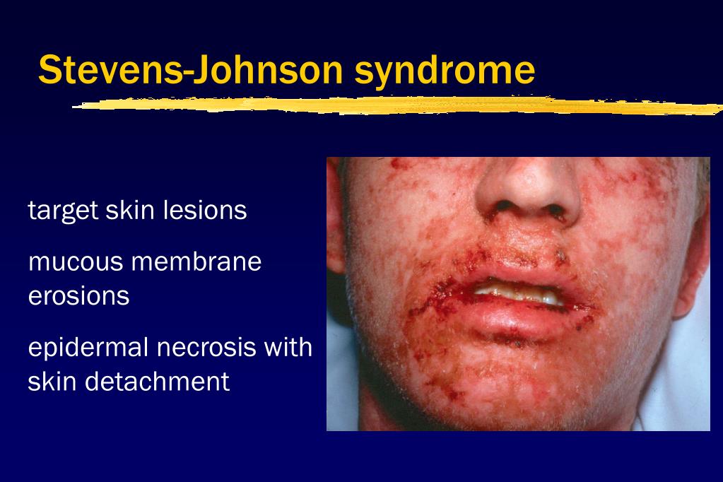 PPT - Drug Therapy of Gout PowerPoint Presentation, free download - ID ...