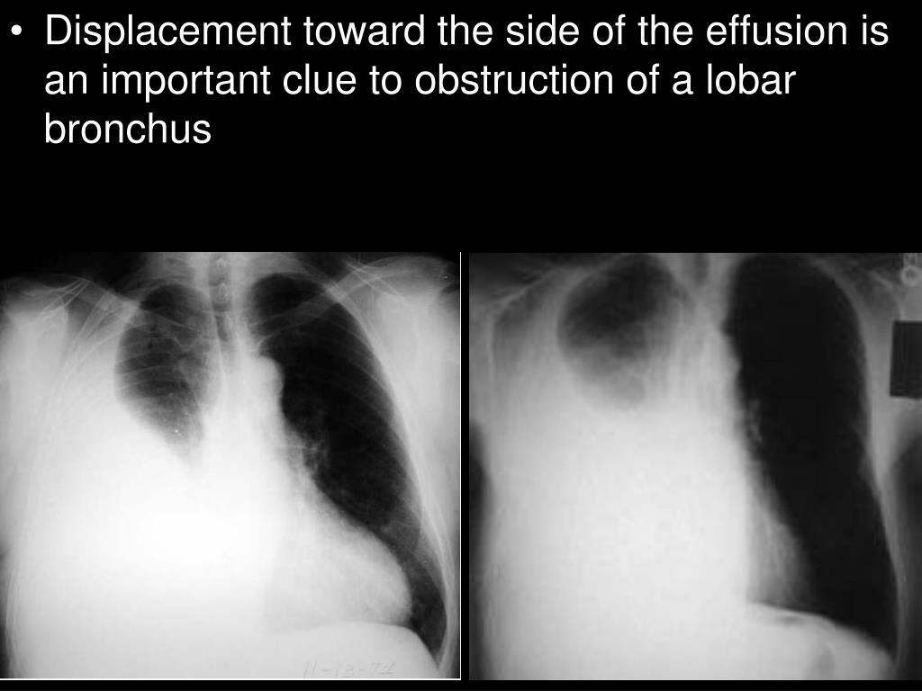 PPT - Diseases of Pleura PowerPoint Presentation, free download - ID ...