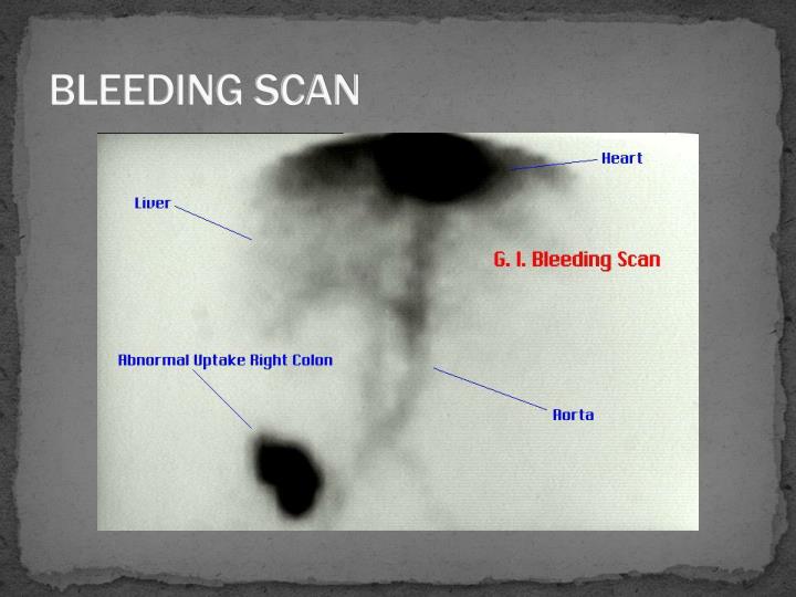 PPT - GASTROINTESTINAL BLEEDING IN PEDIATRICS PowerPoint Presentation ...