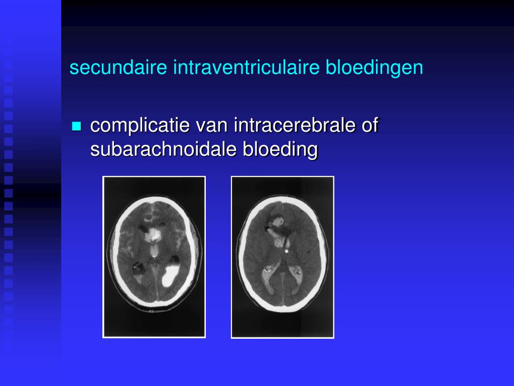 PPT - intraventriculaire bloedingen bij volwassenen PowerPoint ...