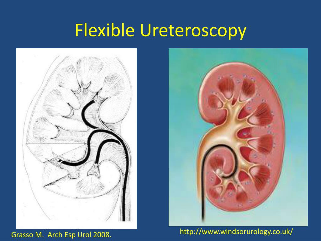 PPT - Surgical Treatment of Renal and Ureteral Stones PowerPoint ...