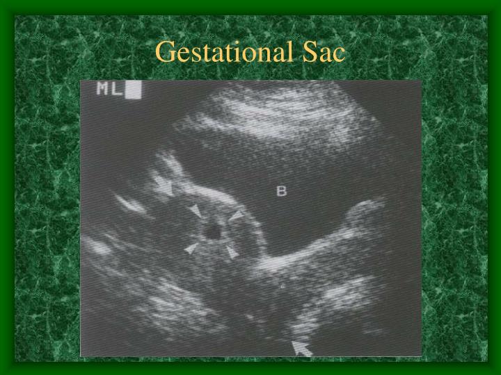 Gestational Sac With Iud In Place