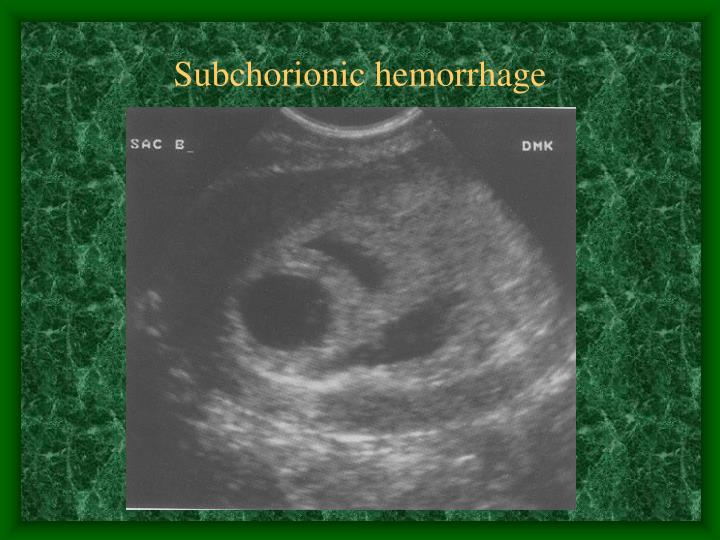 PPT - Radiology Conference First Trimester Bleeding PowerPoint ...