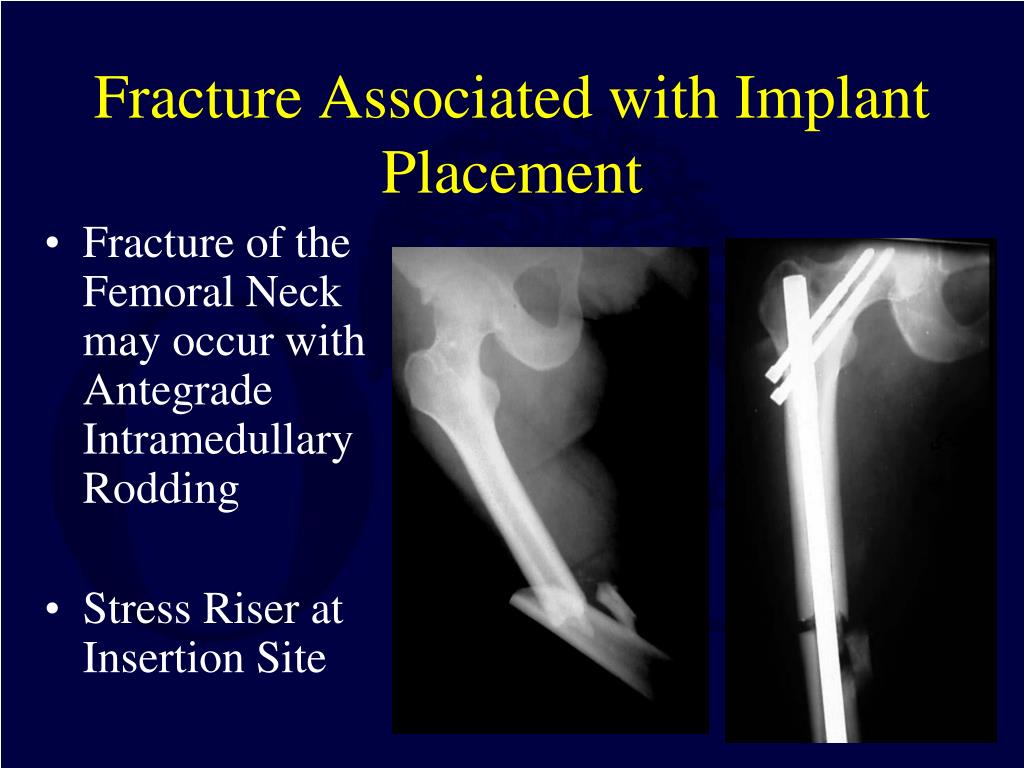 PPT - Treatment of Peri-Implant Fractures of the Femur PowerPoint ...