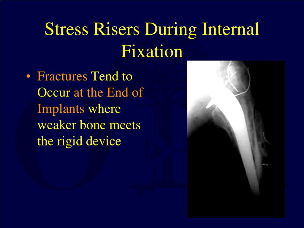 PPT - Treatment of Peri-Implant Fractures of the Femur PowerPoint ...