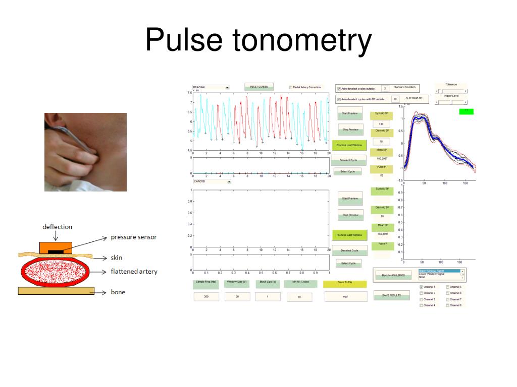 PPT - Effects of endovascular treatment of thoracic aortic diseases on ...