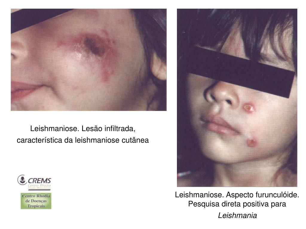 PPT - Leishmaniose. Aspecto clássico da lesão ulcerosa, com bordos ...