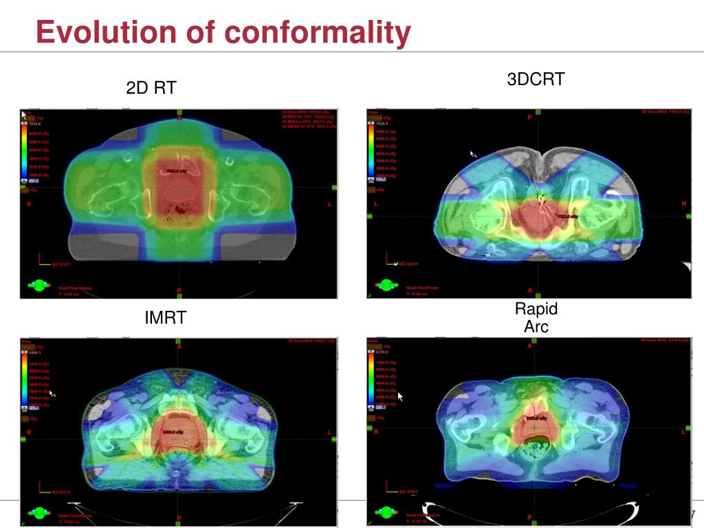 PPT - Controversies in Prostate Cancer PowerPoint Presentation, free ...