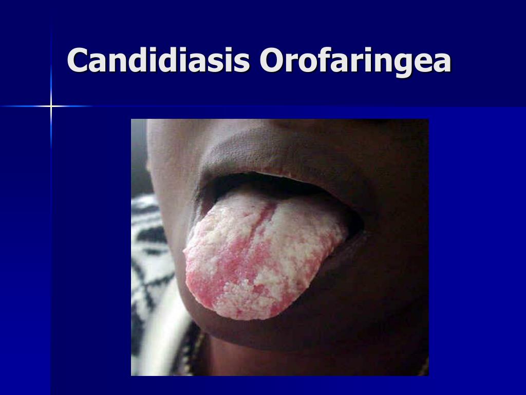 PPT - Manifestaciones dermatológicas que permiten sospechar SIDA ...
