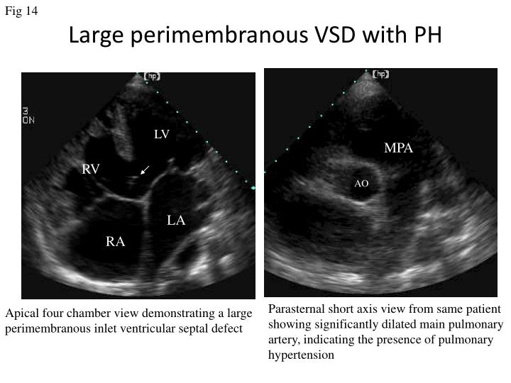 PPT - Ventricular septal defects PowerPoint Presentation - ID:1817608