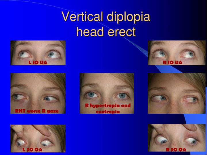 PPT - Working out abnormal head postures PowerPoint Presentation - ID ...