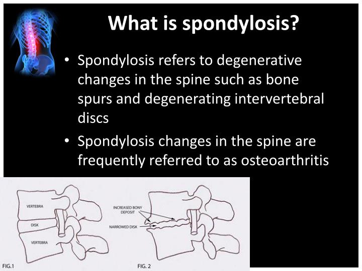 PPT - Lumbar Spondylosis PowerPoint Presentation - ID:1822564