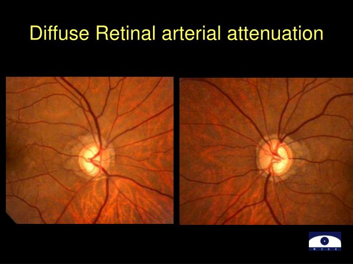PPT - Optic Disc Evaluation IN Glaucoma PowerPoint Presentation - ID ...