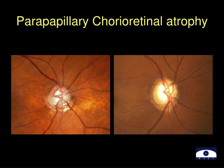 PPT - Optic Disc Evaluation IN Glaucoma PowerPoint Presentation - ID ...