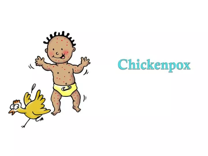 PPT - Chickenpox PowerPoint Presentation, free download - ID:1830554