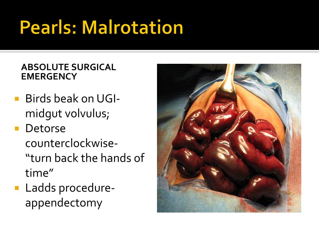 PPT - Pediatric Surgery for the Pediatric Board Review PowerPoint ...