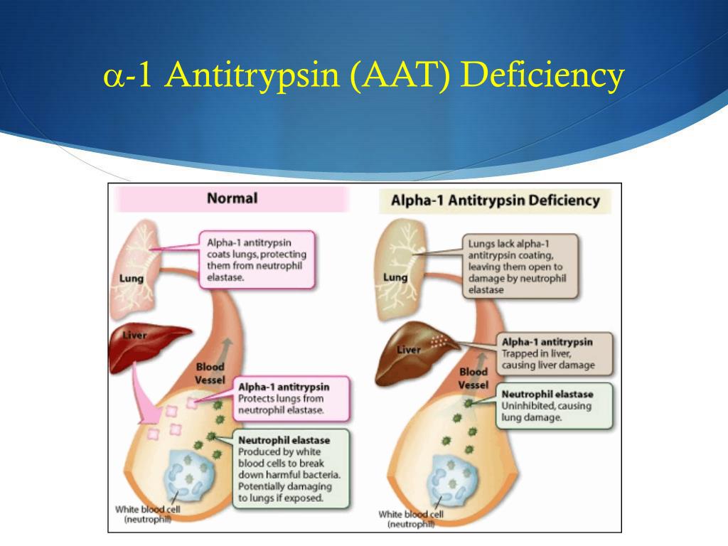 PPT - Hot Topics in Liver Disease Wilson Disease a -1-Antitrypsin ...