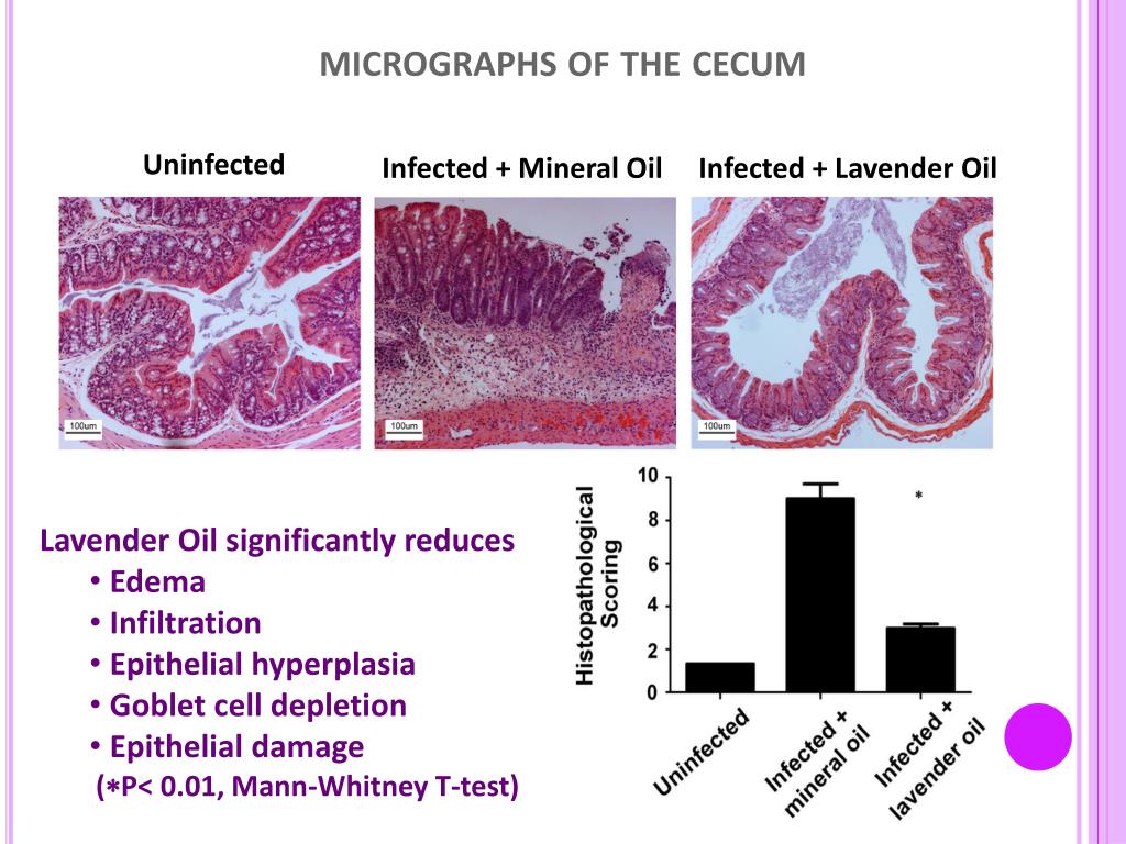 PPT - Inflammatory Bowl Disease (IBD): Colitis PowerPoint Presentation ...