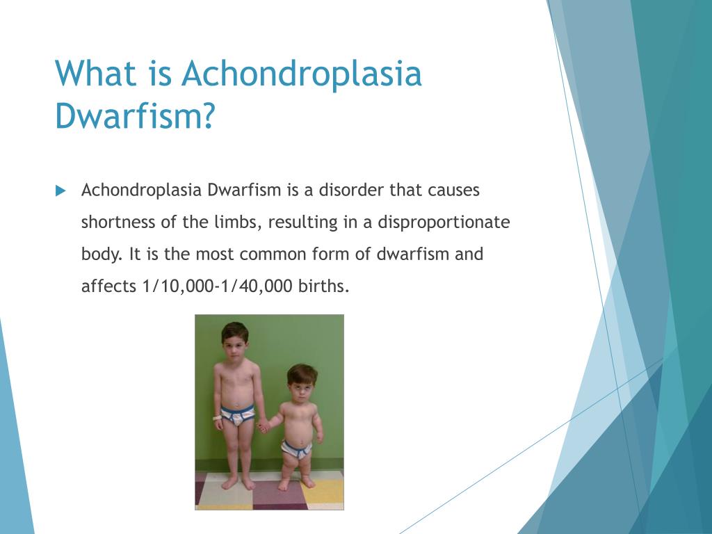 Ppt Achondroplasia Dwarfism Powerpoint Presentation Free Download