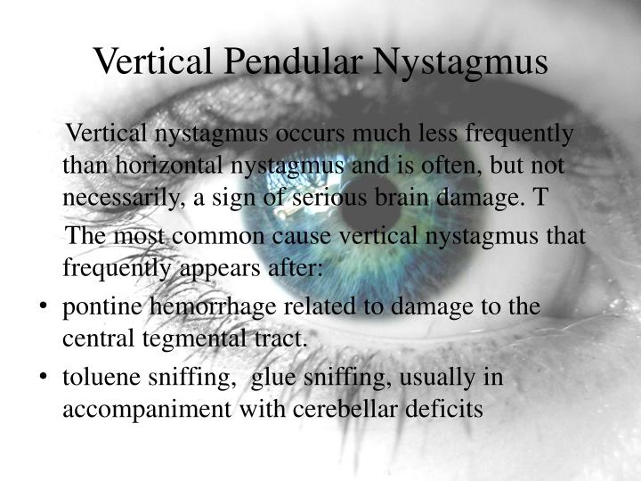 PPT - Nystagmus PowerPoint Presentation - ID:1852222