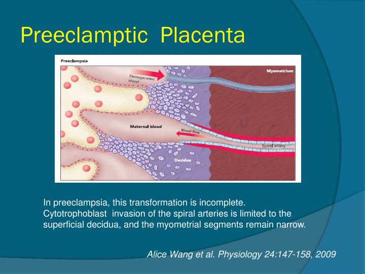 PPT - Pregnancy induced hypertension ( PIH ) & Eclampsia PowerPoint ...
