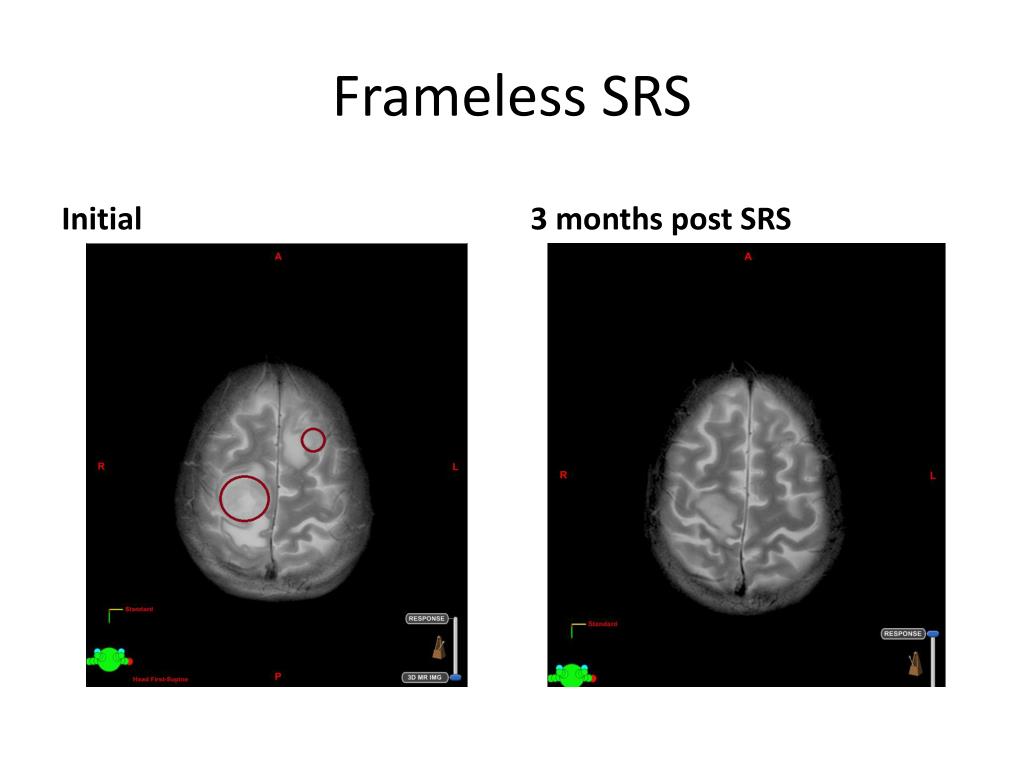 PPT - Recent advances in Radiotherapy of CNS Tumours Dr Vivek Bansal ...