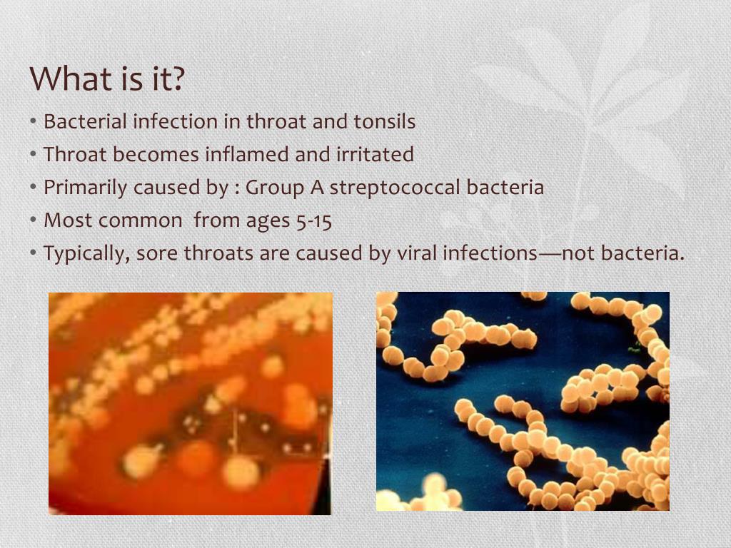 Ppt Strep Throat Streptococcal Pharyngitis Streptococcal Tonsillitis