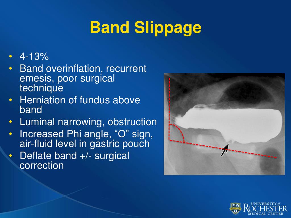 PPT - Imaging of Bariatric Surgery: Normal Anatomy and Postoperative ...