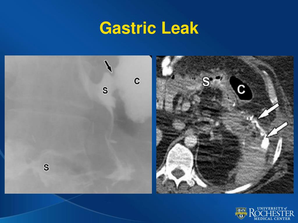 PPT - Imaging of Bariatric Surgery: Normal Anatomy and Postoperative ...