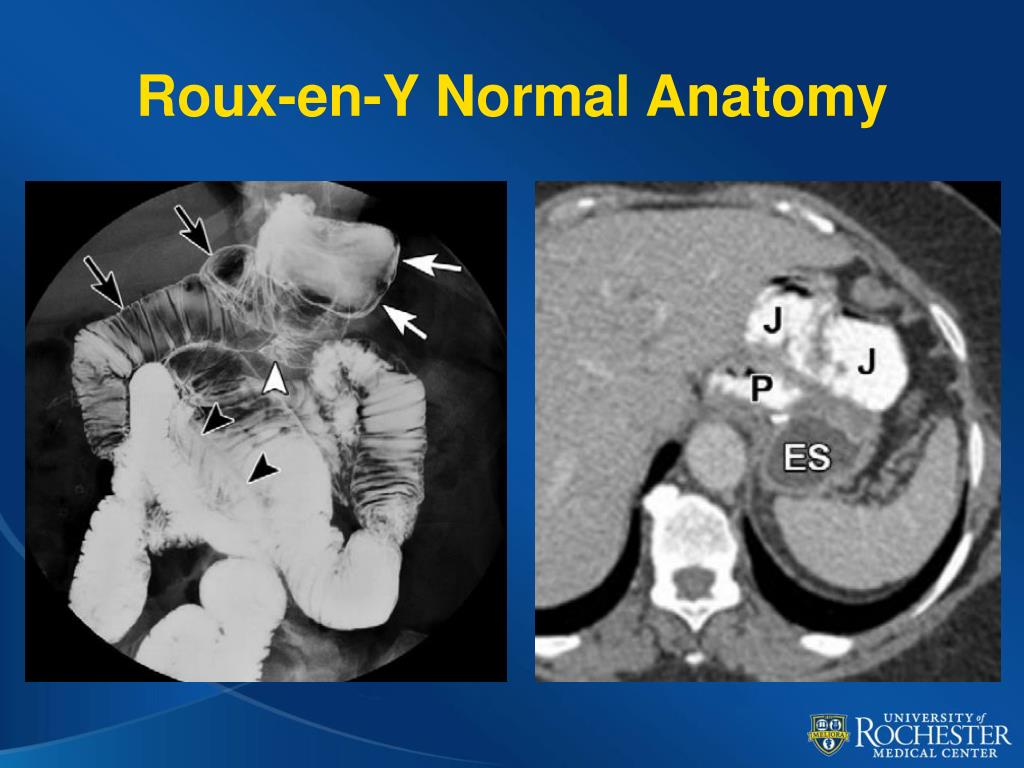 PPT - Imaging of Bariatric Surgery: Normal Anatomy and Postoperative ...