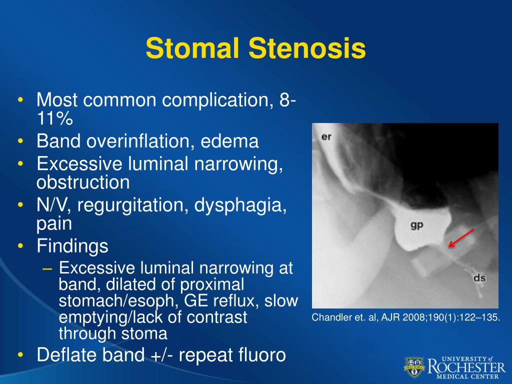 PPT - Imaging of Bariatric Surgery: Normal Anatomy and Postoperative ...