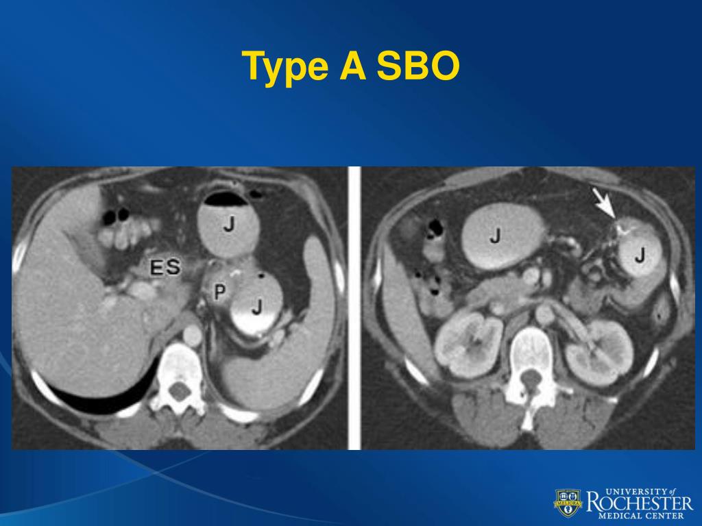PPT - Imaging of Bariatric Surgery: Normal Anatomy and Postoperative ...