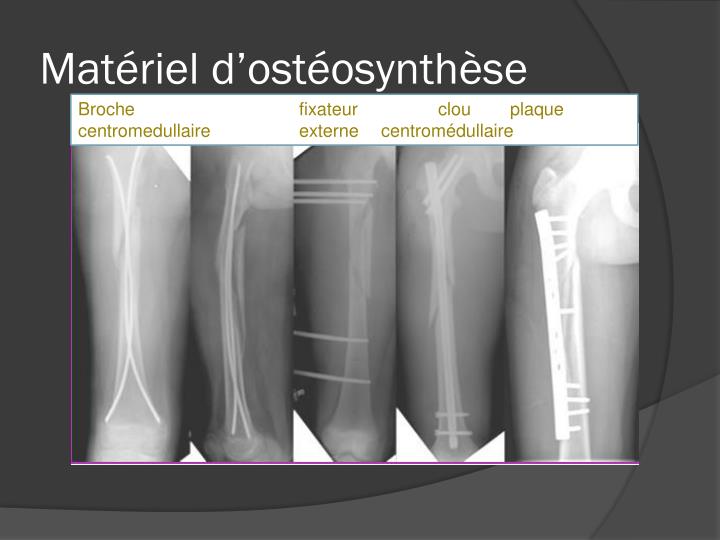 PPT - Processus traumatique PowerPoint Presentation - ID:1861857