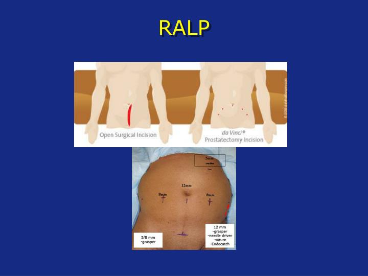 PPT - Radical Prostatectomy for Prostate Cancer PowerPoint Presentation ...