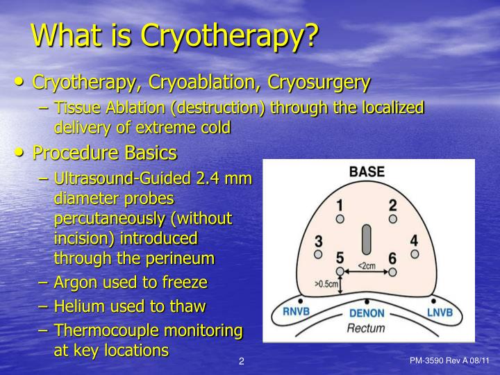 PPT - Prostate Cryotherapy Minimally Invasive Cancer Treatment ...