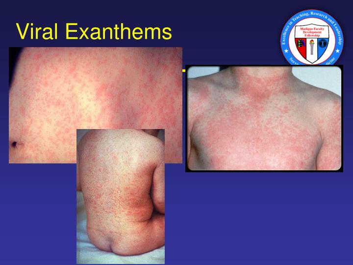 PPT - Is it Only Skin Deep? Dermatologic Evidence of Systemic Disease ...