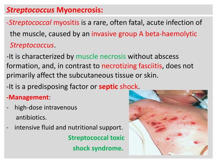 PPT - Infectious Myositis: PowerPoint Presentation - ID:1865298