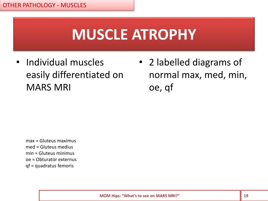PPT - Metal-on-metal hips. “What’s to see on MRI?” PowerPoint ...