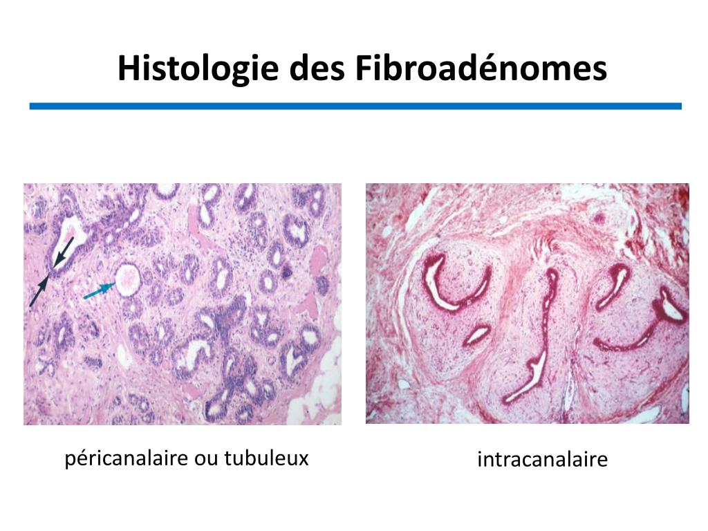 PPT - Fibroadénome géant de l’adolescente et influence hormonale ...