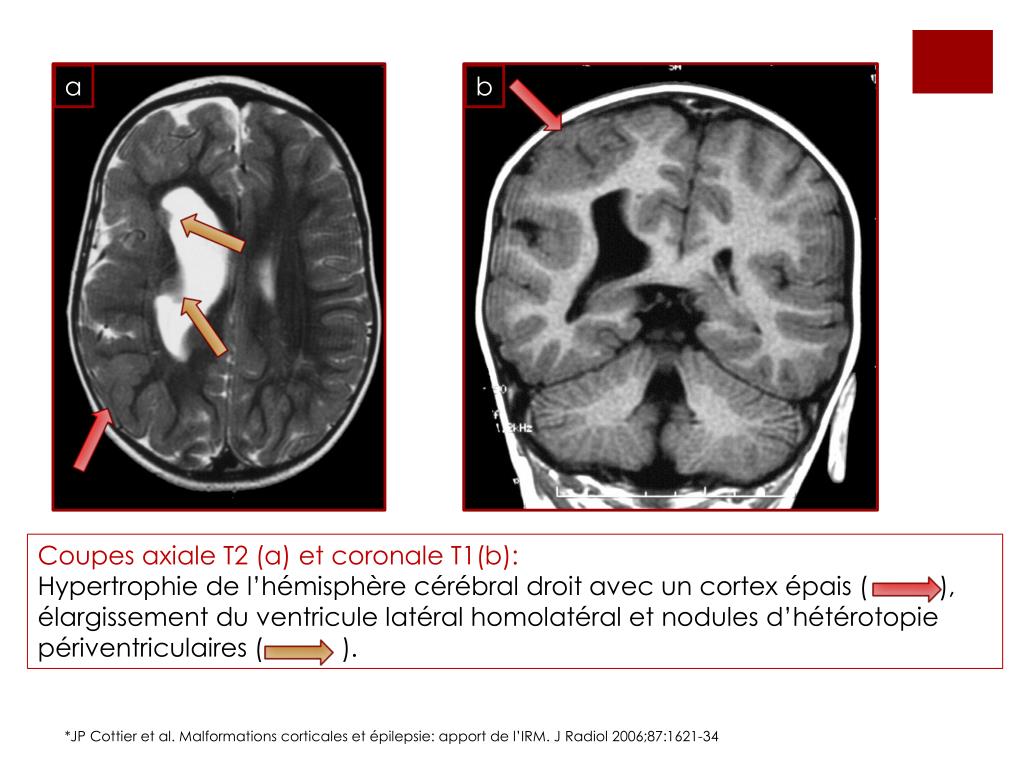 PPT - LES ANOMALIES DE DÉVELOPPEMENT CORTICAL: CE QUE LE RADIOLOGUE ...