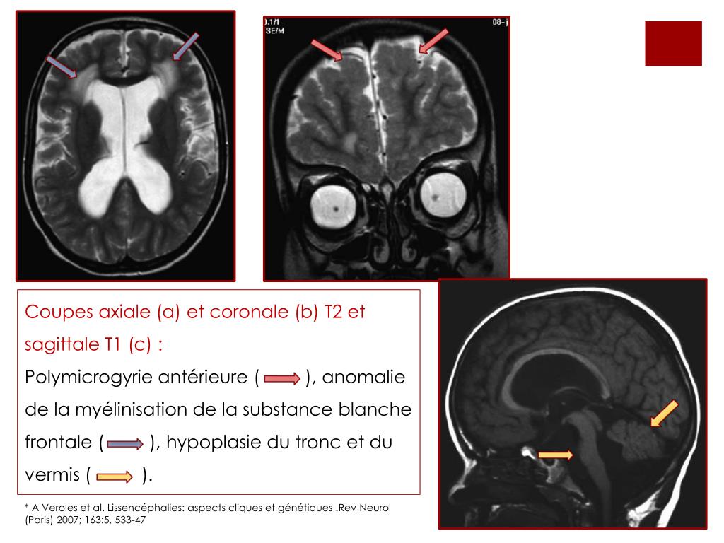 PPT - LES ANOMALIES DE DÉVELOPPEMENT CORTICAL: CE QUE LE RADIOLOGUE ...