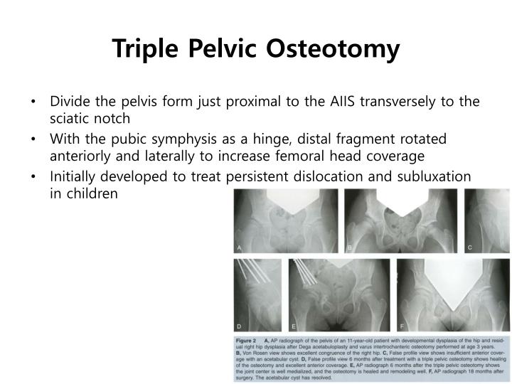 PPT - Alternatives to Periacetabular Osteotomy (PAO) for Adult ...