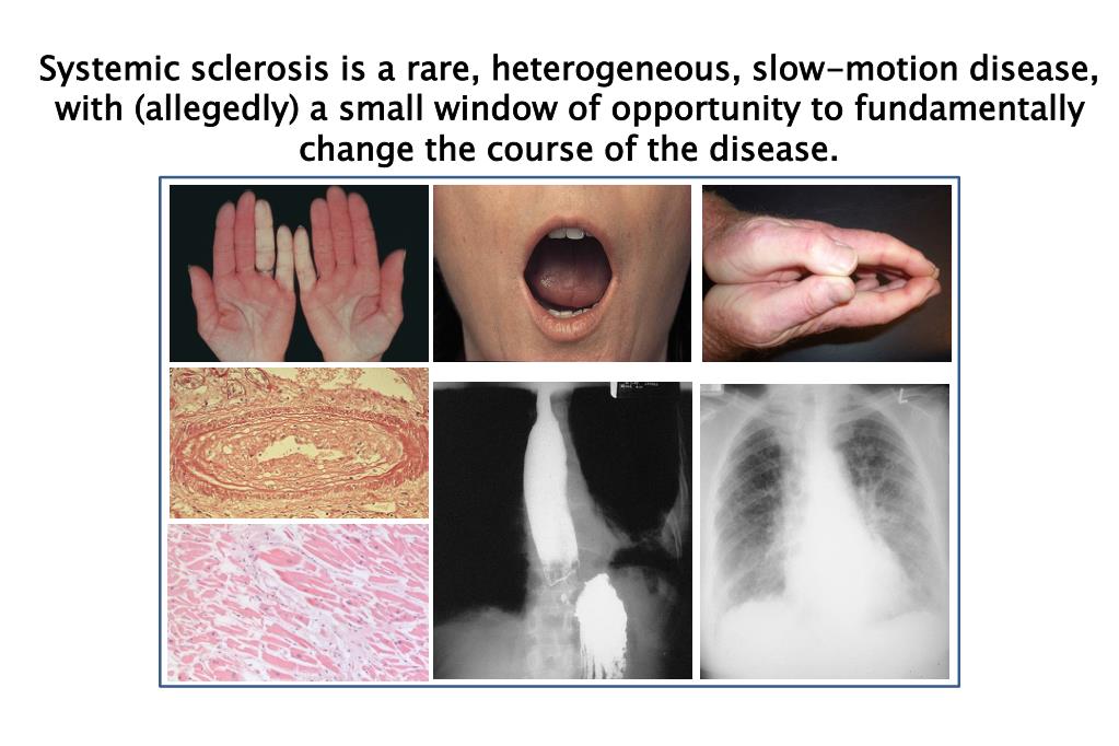 Systemic Sclerosis
