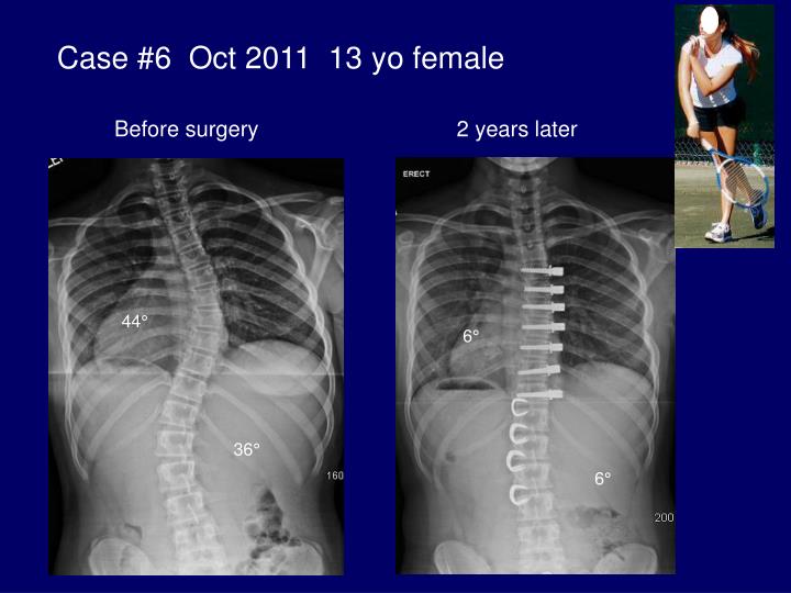 PPT - Vertebral Body Tethering (VBT) In 2014 PowerPoint Presentation ...