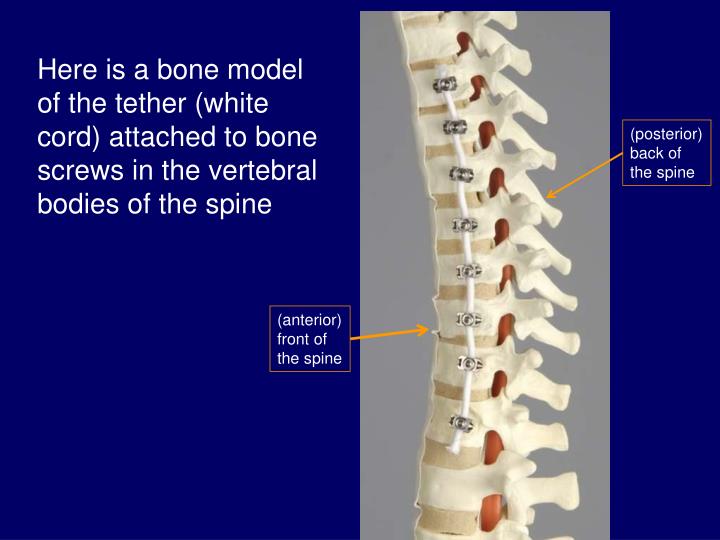 PPT - Vertebral Body Tethering (VBT) In 2014 PowerPoint Presentation ...