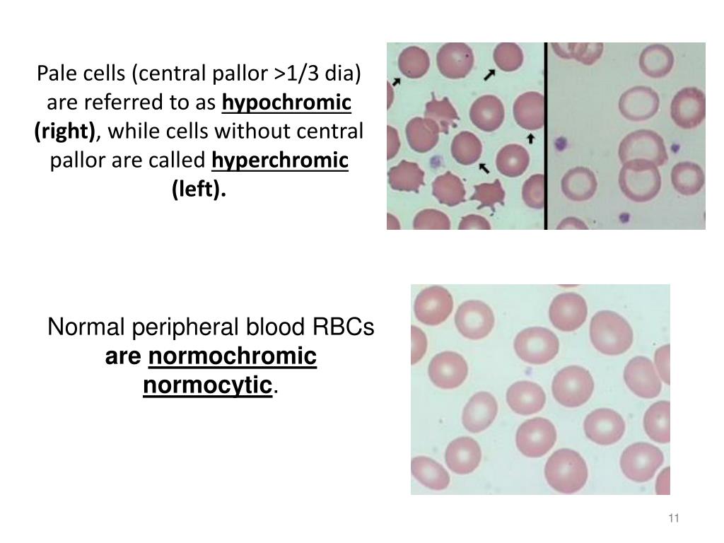 PPT - BLOOD 2 RED BLOOD CELLS JAUNDICE ANEMIA & POLYCYTHEMIA PowerPoint ...
