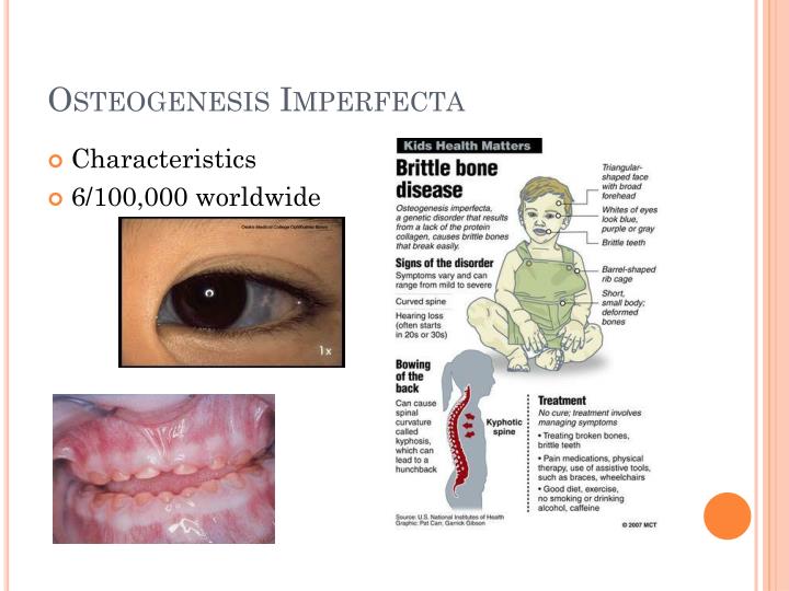PPT - Osteogenesis Imperfecta COL1A1 PowerPoint Presentation - ID:1867476